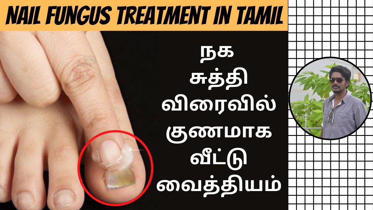 நக சுத்திக்கு வீட்டு வைத்தியம் | Naga Suthi Treatment In Tamil | Nail ...