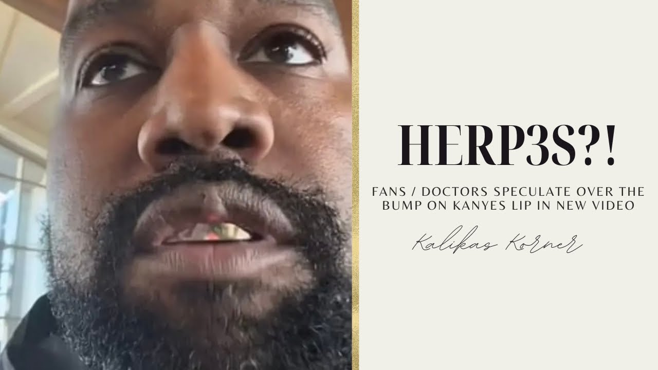 Kanye has the HERP!? Fans Freak out over Bump on Kanye’s Lip in new ...