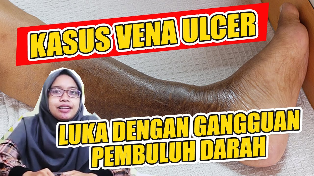 Luka dengan Kasus Vena Ulcer - YouTube