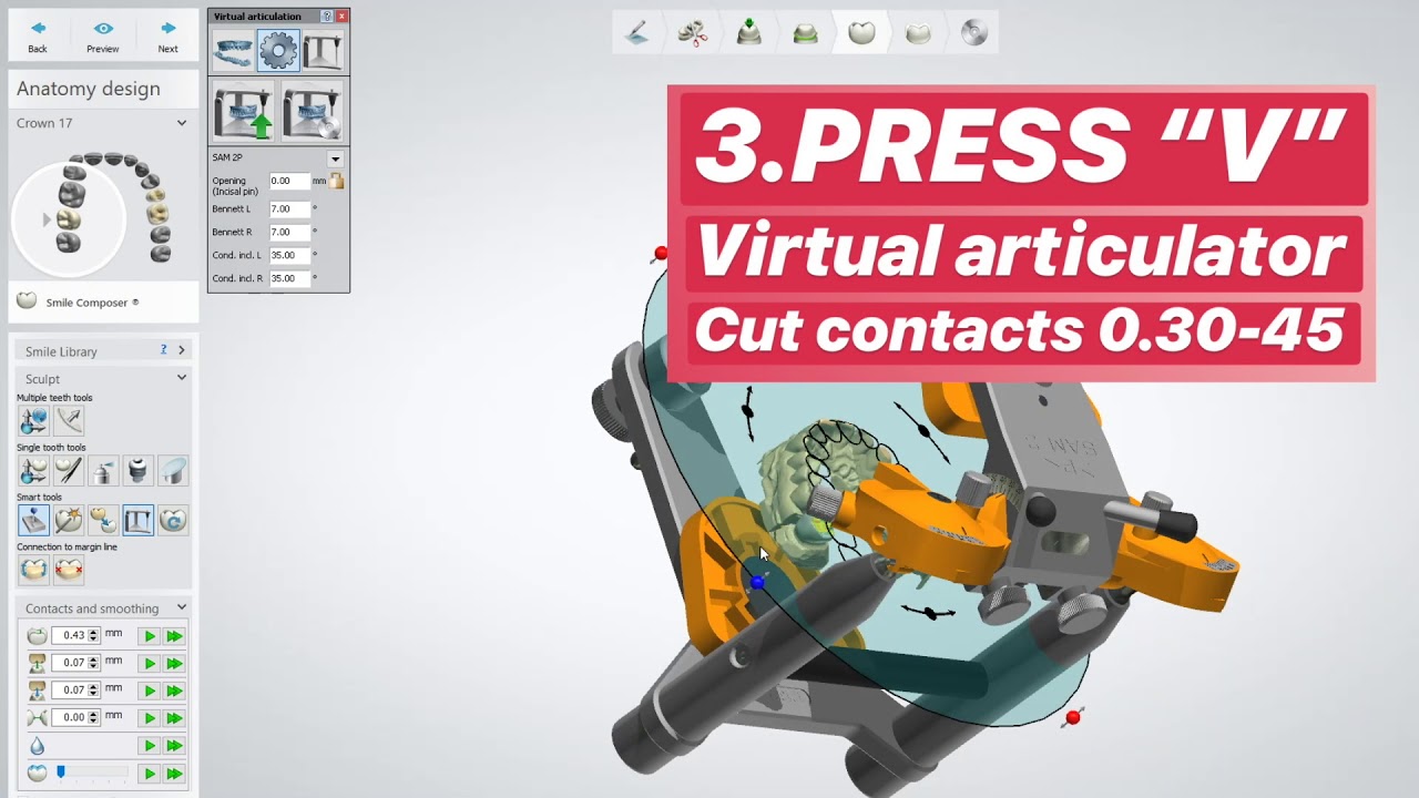 3Shape Occlusion Settings (2019) - YouTube