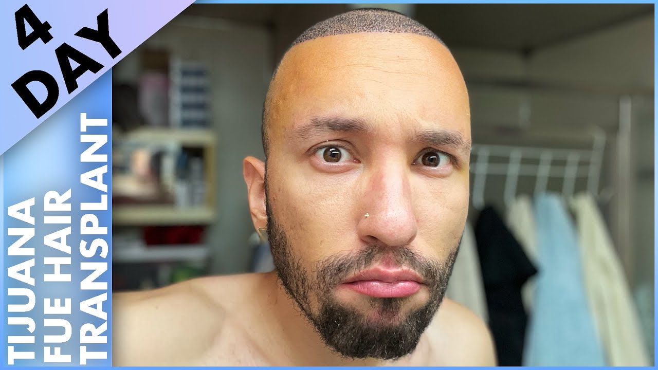 Day 4 | FUE Hair Transplant In Tijuana | Biracial Black Afro Hair - YouTube