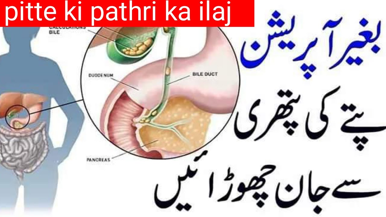pittay ki pathri ka ilaj in urdu I pittay ki pathri ka ilaj I pitay ki pathri ka ilaj - YouTube