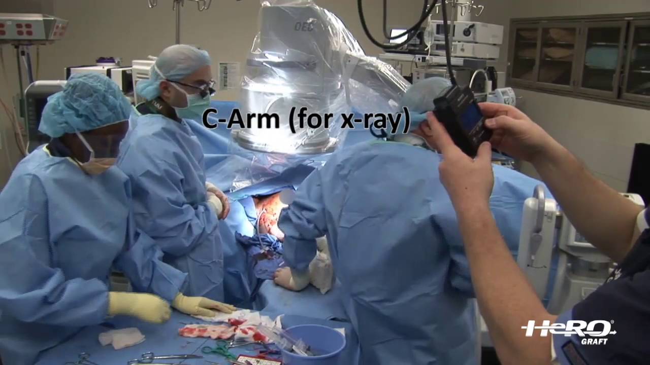 HeRO® Graft - Surgical Implant with Dr. Glickman - YouTube