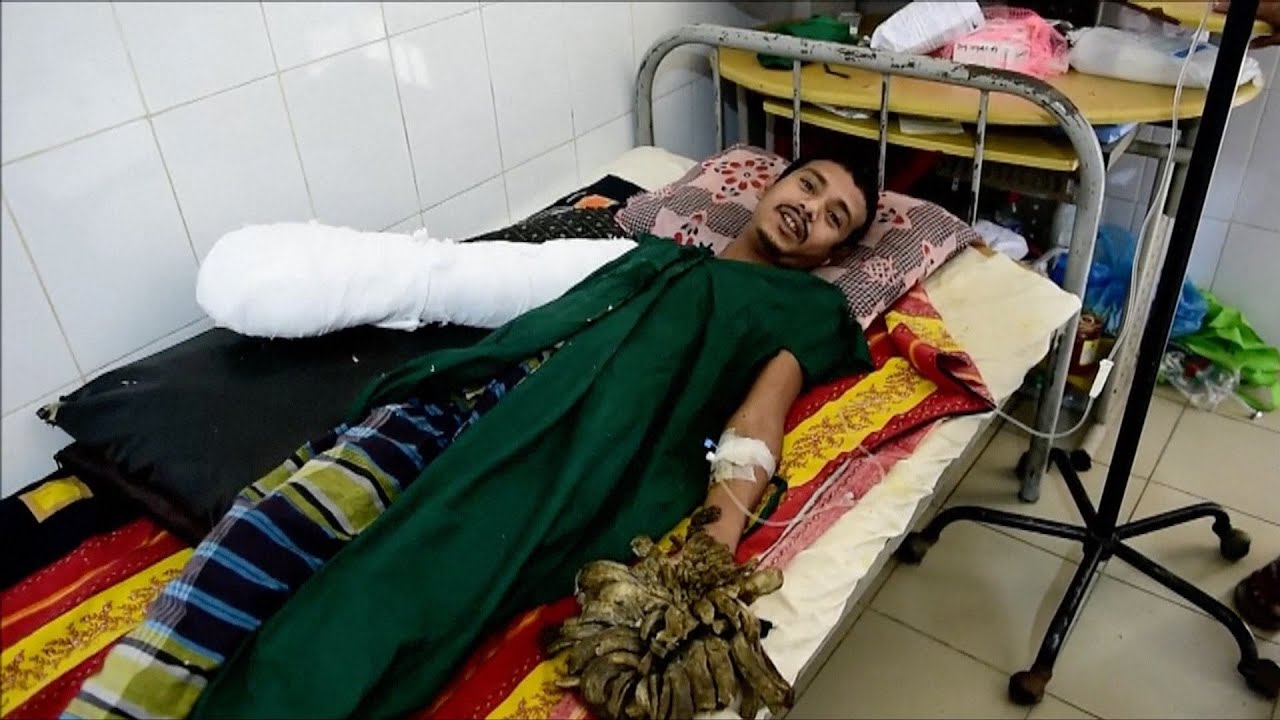 three@five : ‘Tree man’ underwent successful surgery - YouTube