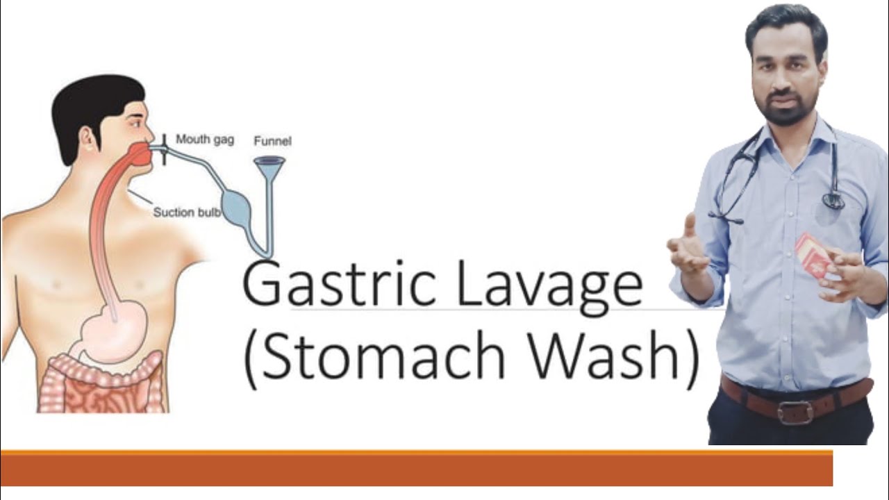 GASTRIC LAVAGE| STOMACH WASH| STOMACH IRRIGATION| ICU PROCEDURE| DR ...