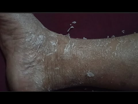 clean the feet of skin that is peeling due to skin change ~ Callus ...
