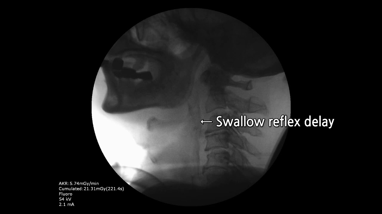 VFSS_analysis, Dysphagia treatment & intervention : VFSS 영상분석 및 치료(중재 ...