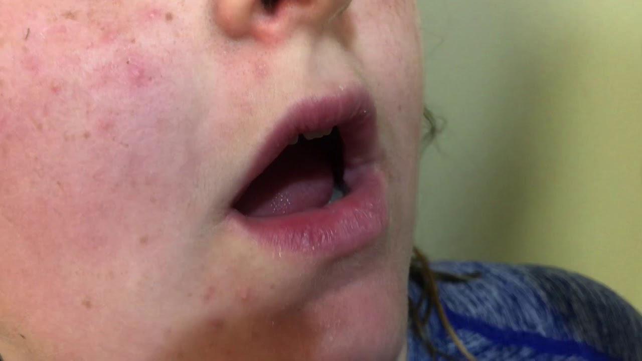 Lower lip pull - YouTube