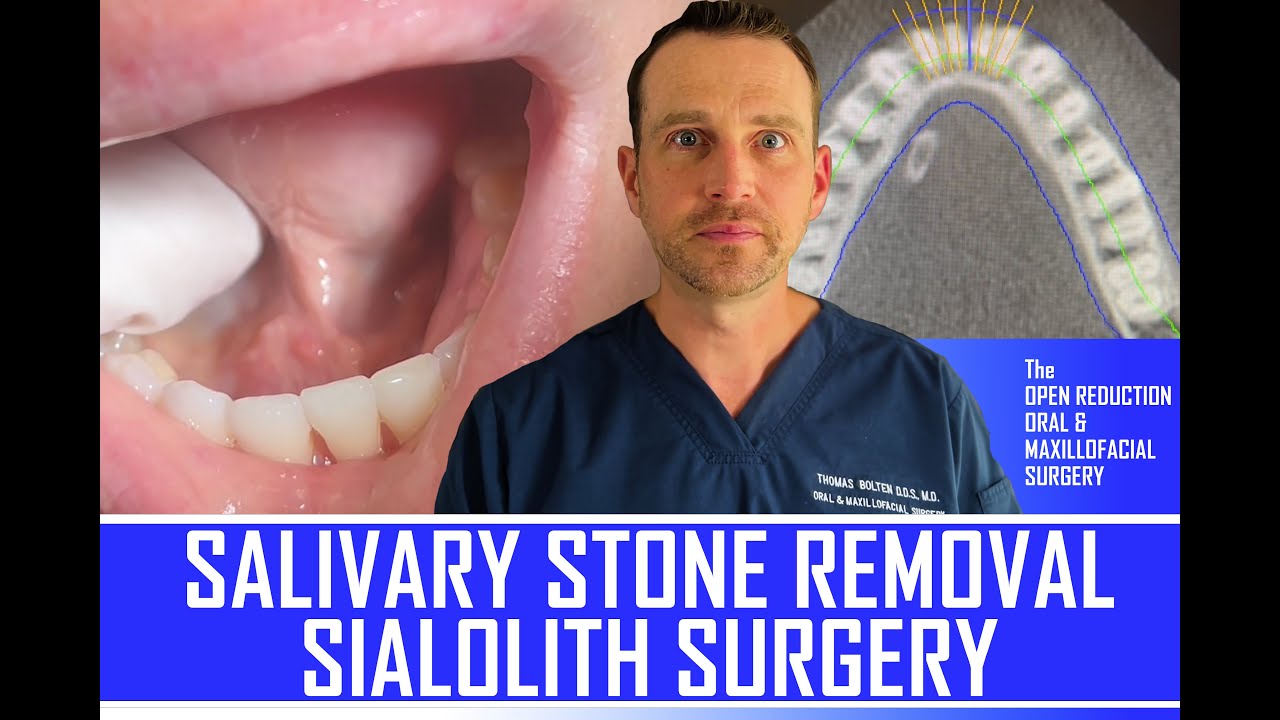 SALIVARY STONE REMOVAL - YouTube