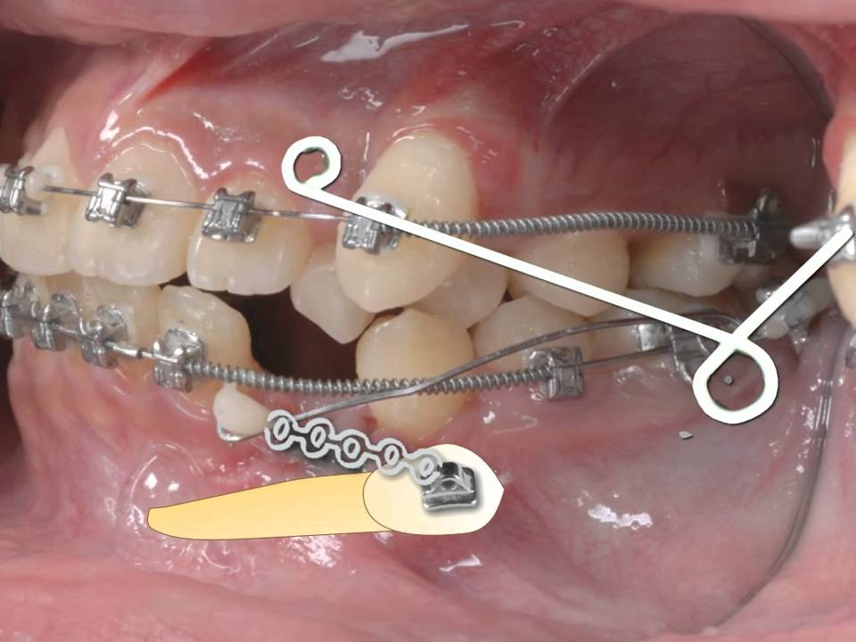 Lower Impacted-Damon 3 - YouTube