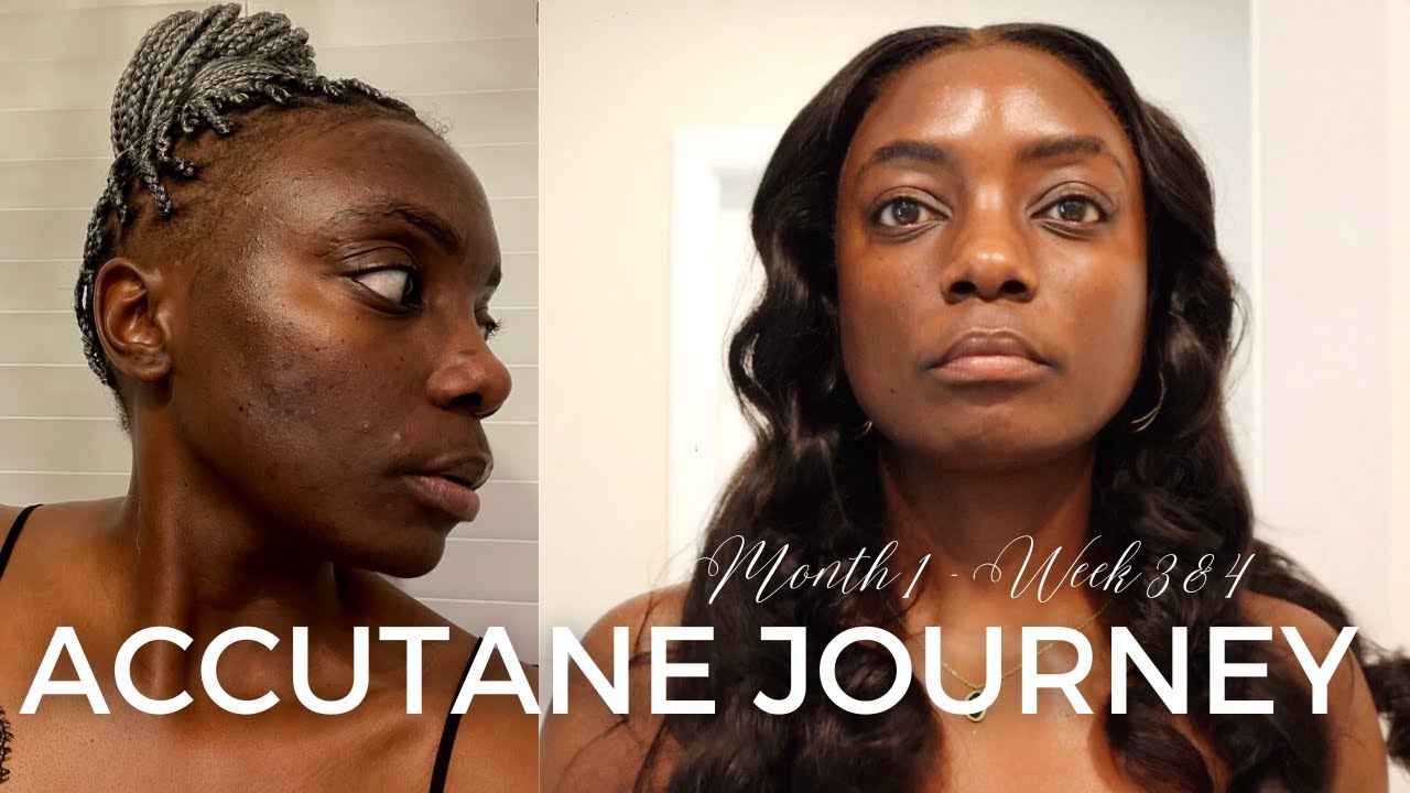 ACCUTANE JOURNEY MONTH 1 : WEEK 3 & 4 ON ISOTRETINOIN | SKIN DARKENING ...