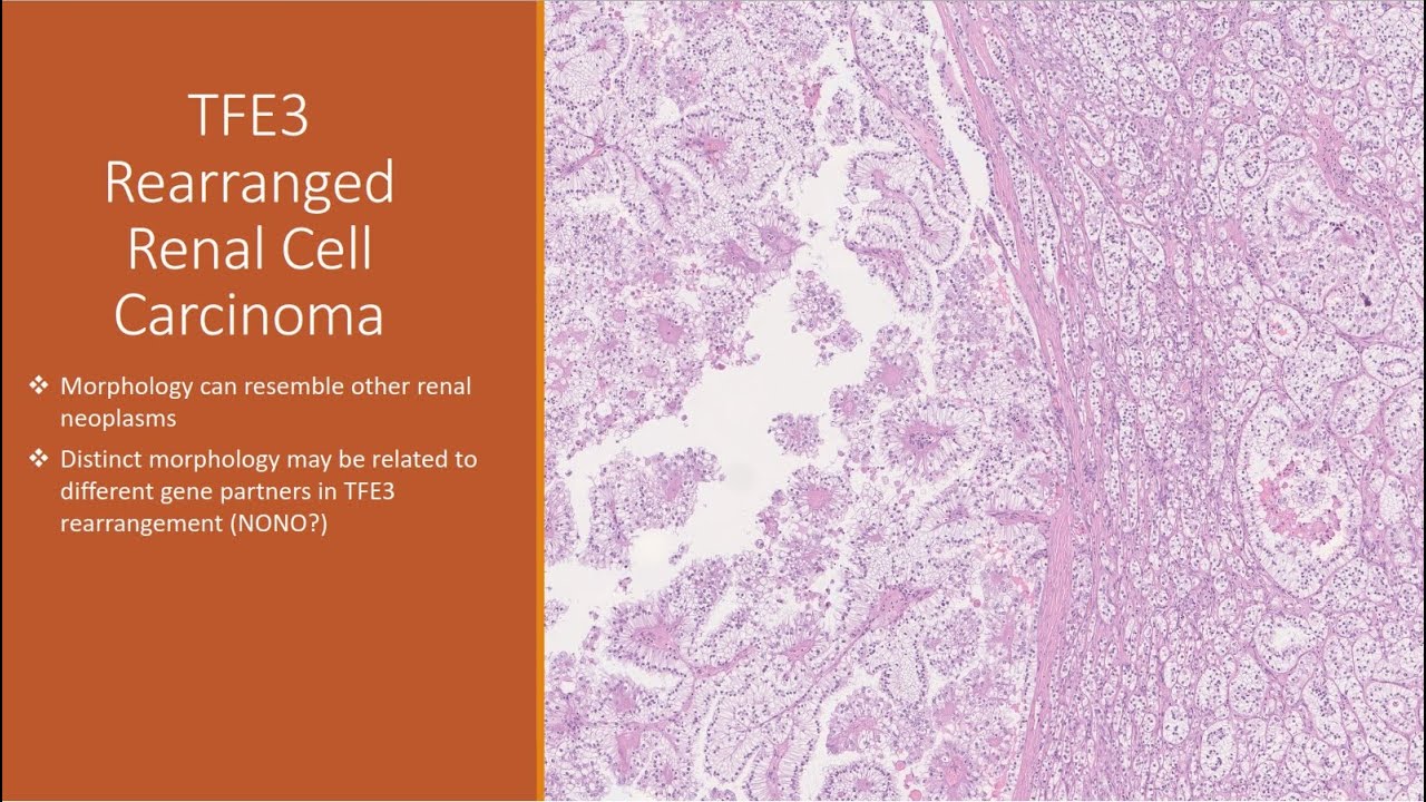 Urolojik Patoloji #5 TFE3 Gene Rearranged Renal Cell Carcinoma. - YouTube