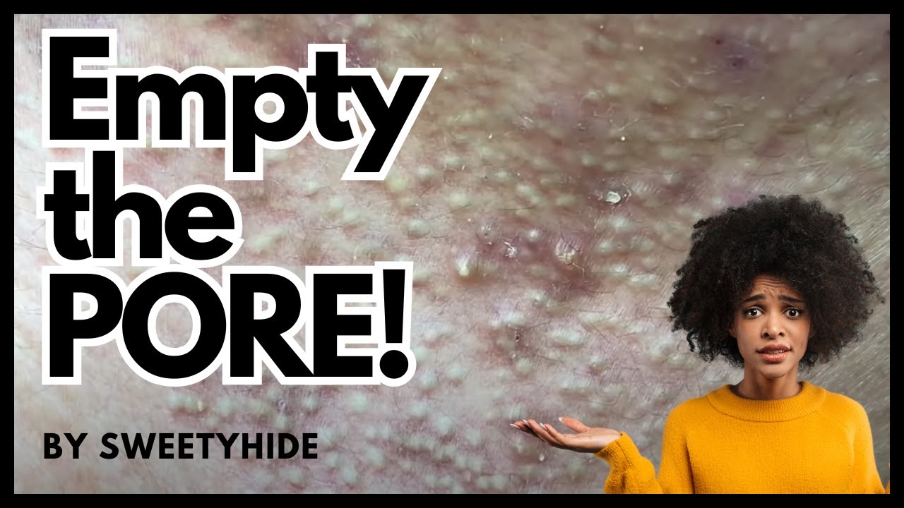 EMPTY the darn PORE!! - YouTube