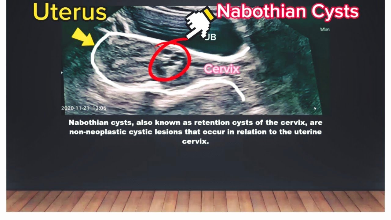 What are Nabothian Cysts | Ultrasound study | Urdu | Hindi - YouTube