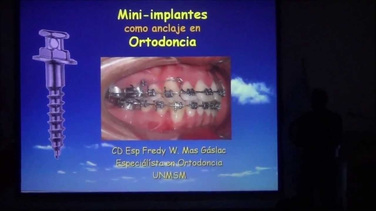 Mini implantes como anclaje en Ortodoncia - YouTube