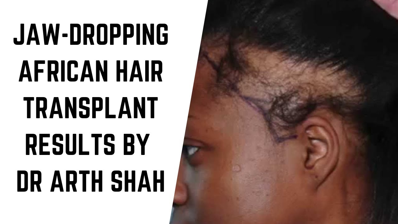 From Disappointment to Triumph: Jaw-Dropping African Hair Transplant ...