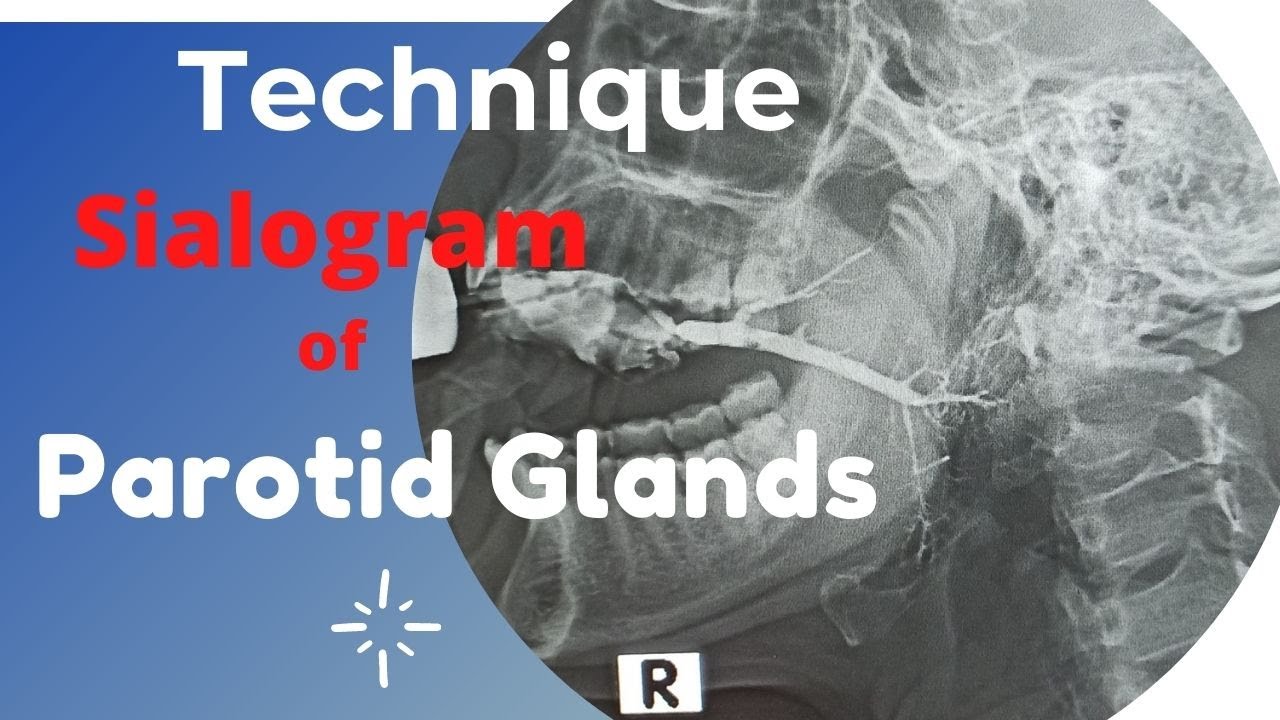 Sialogram of Parotid gland (Ep-53) | Technique of parotid gland ...