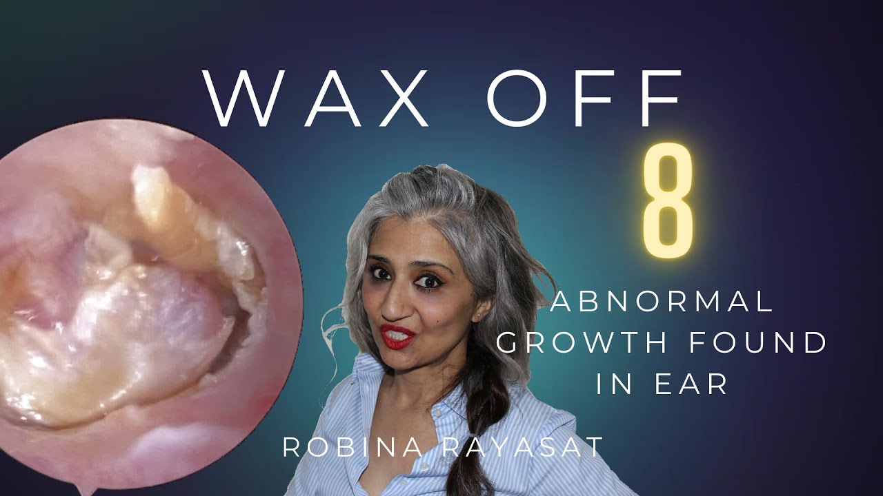 Abnormal Growth Found In Ear | Wax Off - Episode 8 - YouTube