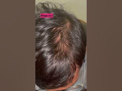CARA NUMBUHIN RAMBUT PITAK DALAM 2 MINGGU - YouTube