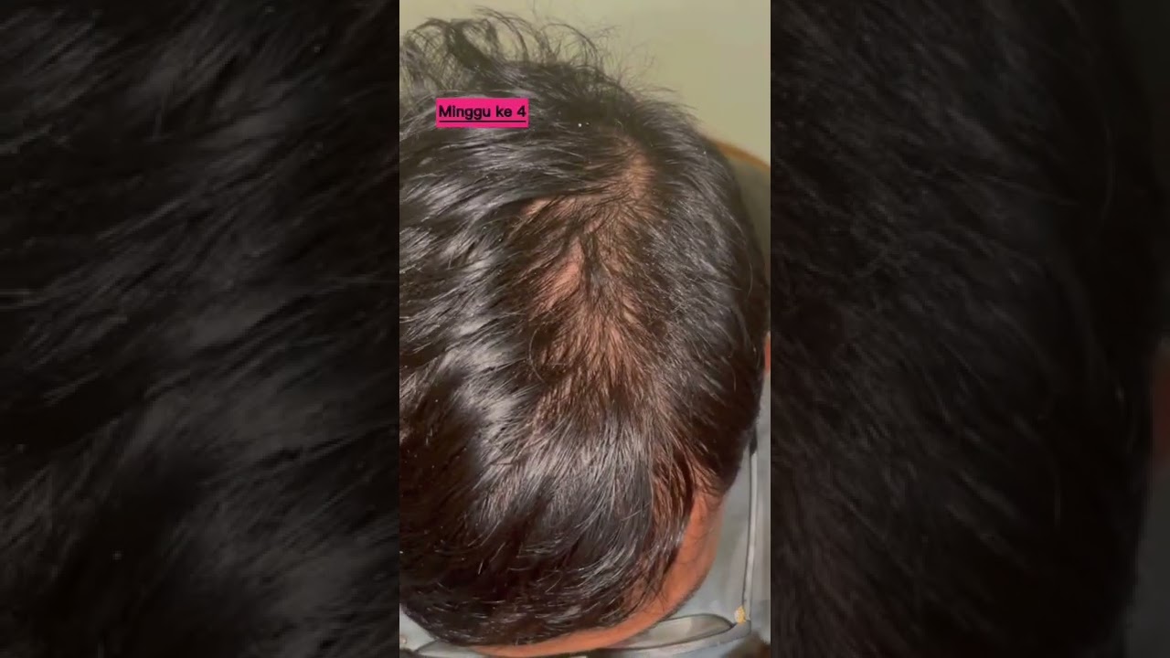 CARA NUMBUHIN RAMBUT PITAK DALAM 2 MINGGU - YouTube