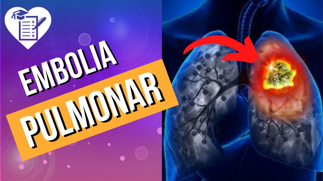 EMBOLIA PULMONAR – Causas, Sintomas e Tratamento - YouTube