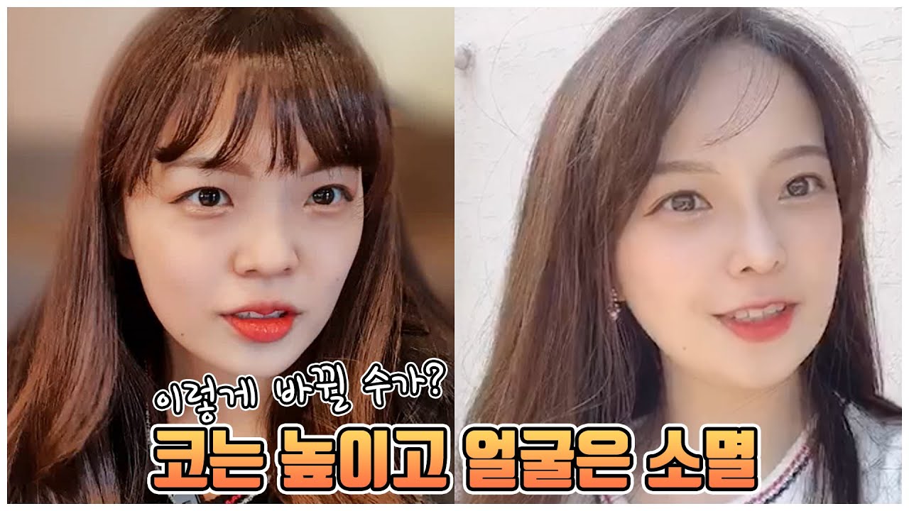 Maxmax Vlog 안면윤곽 3종 턱끝 광대 사각턱 윤곽을 더 화려하고 매끄럽게 코성형 눈밑지방재배치 풀페이스 지방이식으로 얼굴이 볼륨감 있게 변신했어요