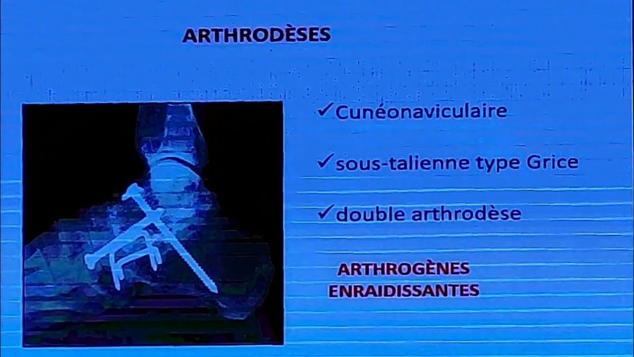 Comment aborder le pied plat valgus de l'enfant - YouTube