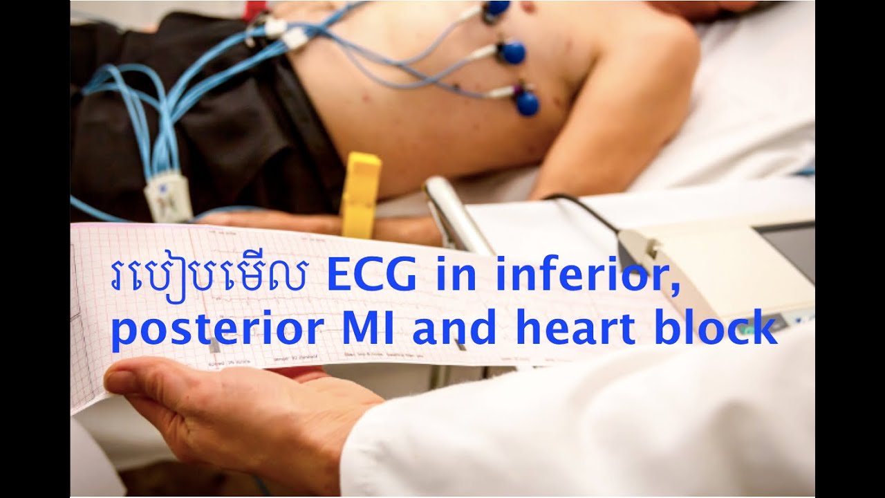 ECG Inferior Posterior MI and complete heart block - YouTube