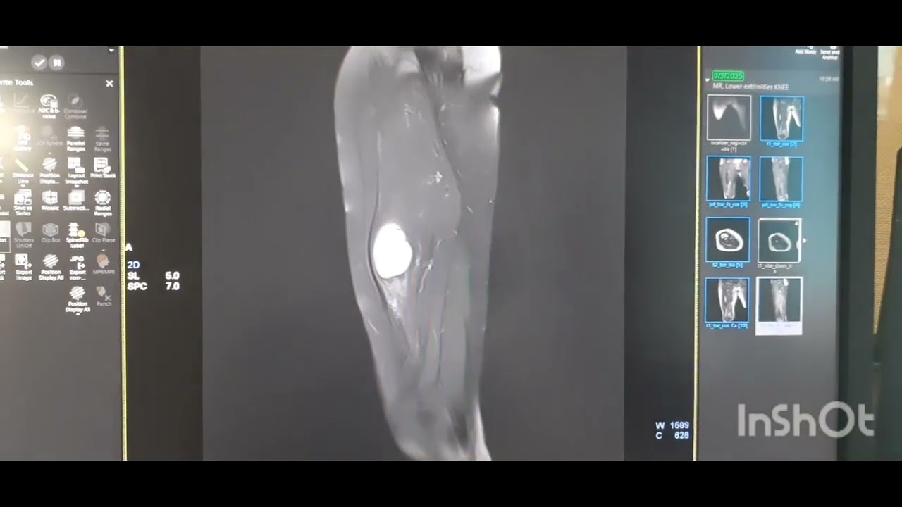 Thigh benign cyst MRI - YouTube