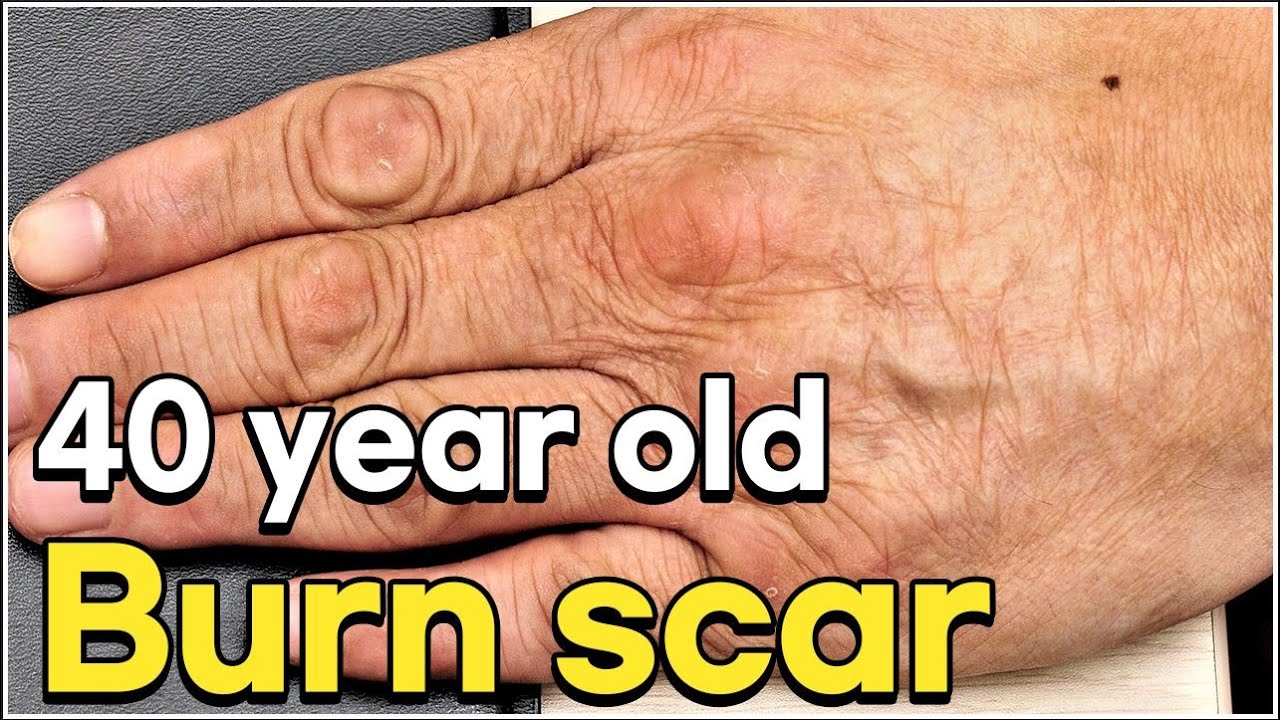 40 year old burn scar - back of the hand. - YouTube