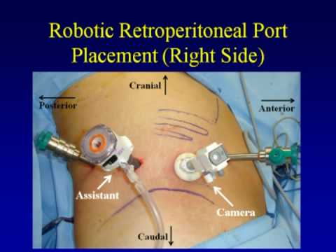 Retroperitoneal Robotic Kidney Surgery: Technique and Early Results ...