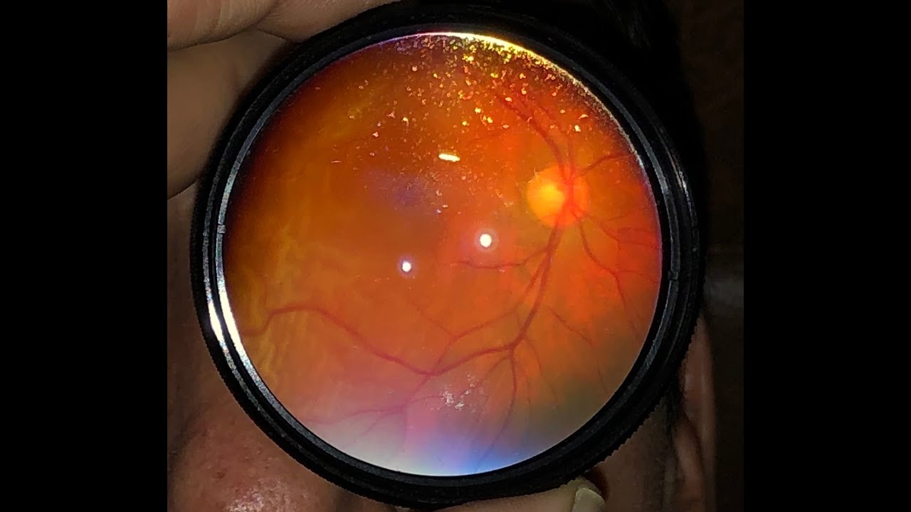 Buckle Vitrectomy with Peripheral Retinotomy for Retinal Shortening PVR ...