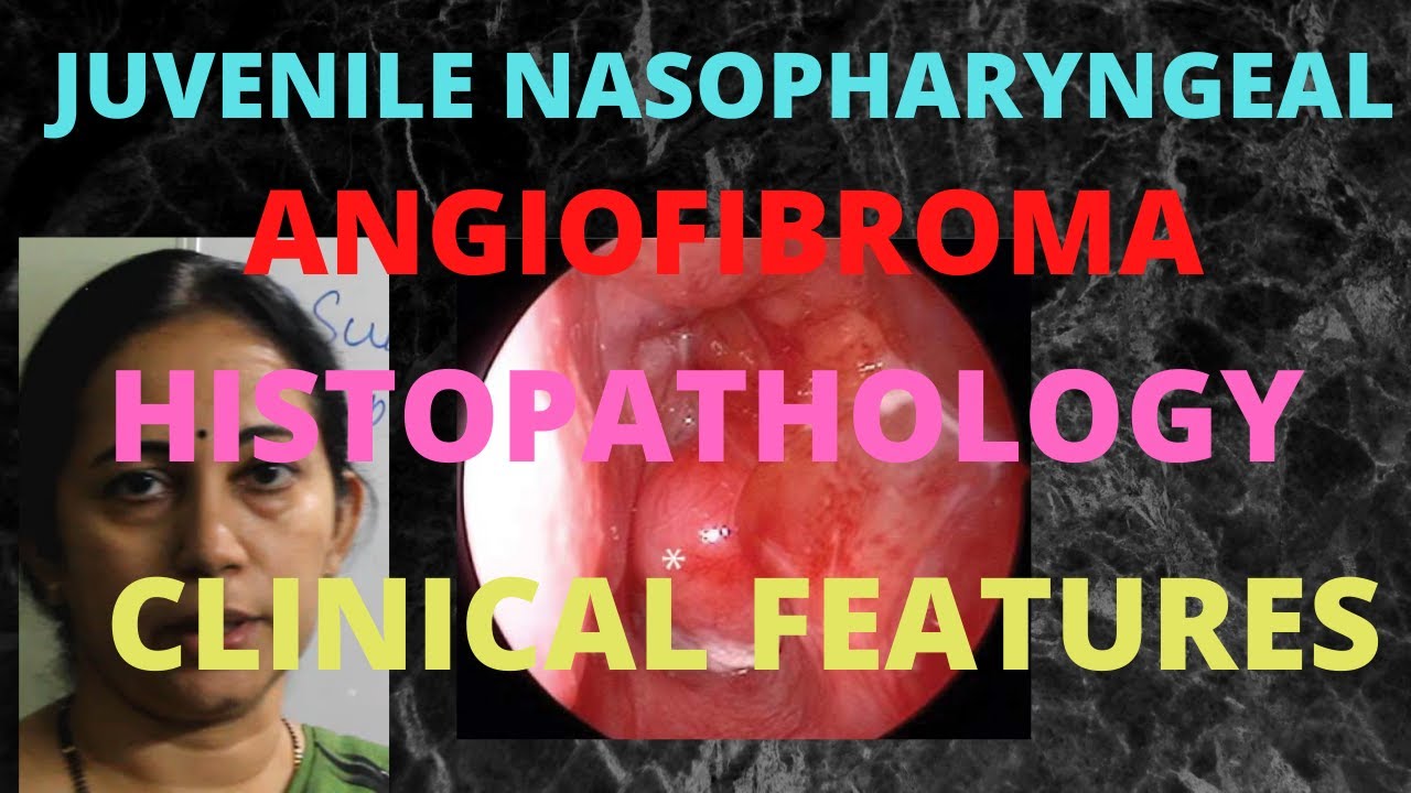 160.Juvenile Nasopharyngeal Angiofibroma Part3 #histopathology # ...