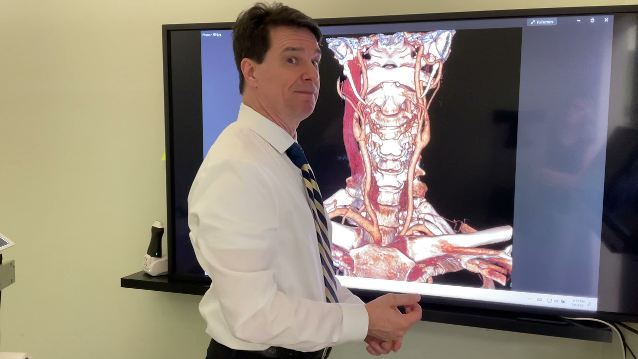 Release of entrapped jugular vein and vagus nerve ganglion. - YouTube