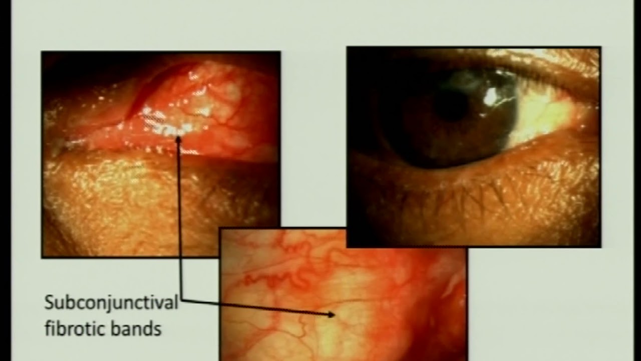 AIOC2018 - IC009 - Topic - Biopsy techniques of conjunctival and ...