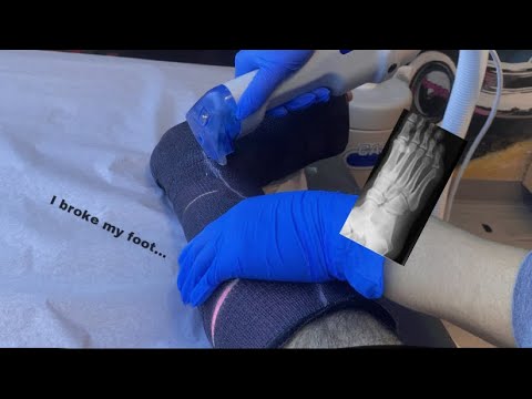 Getting My cast off... - YouTube