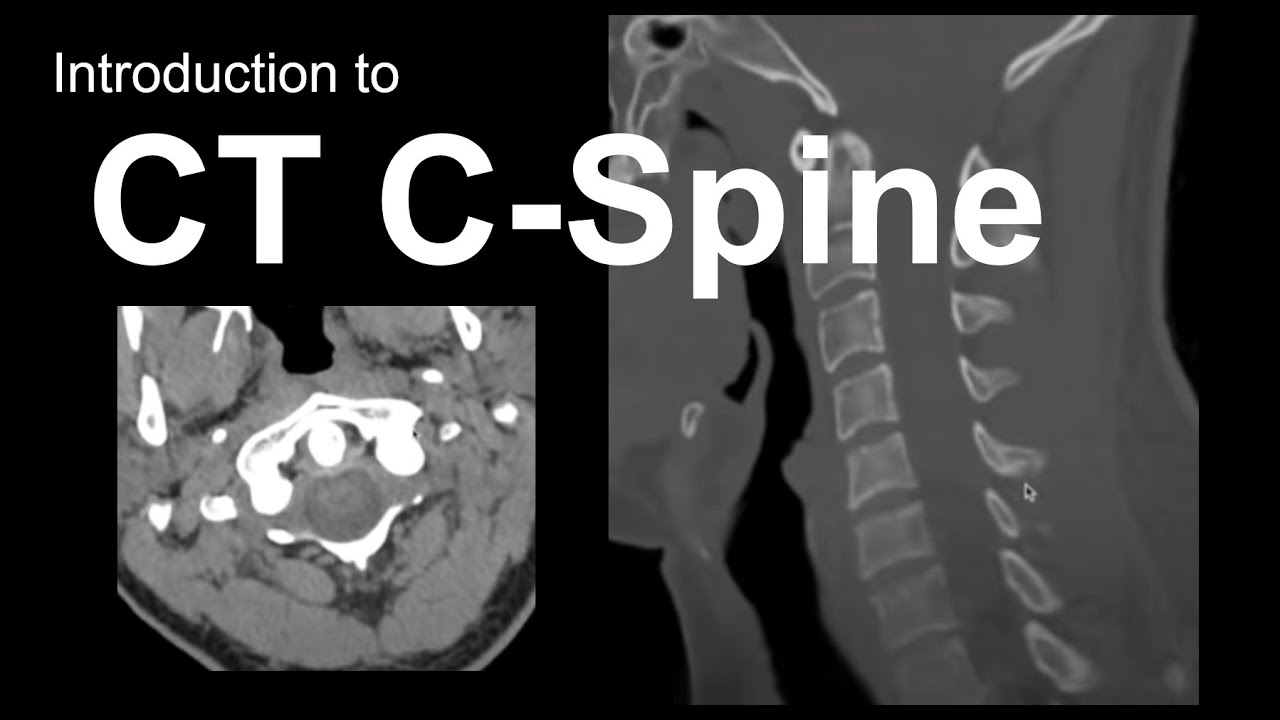 Introduction to CT C-spine: Approach and Essentials - YouTube