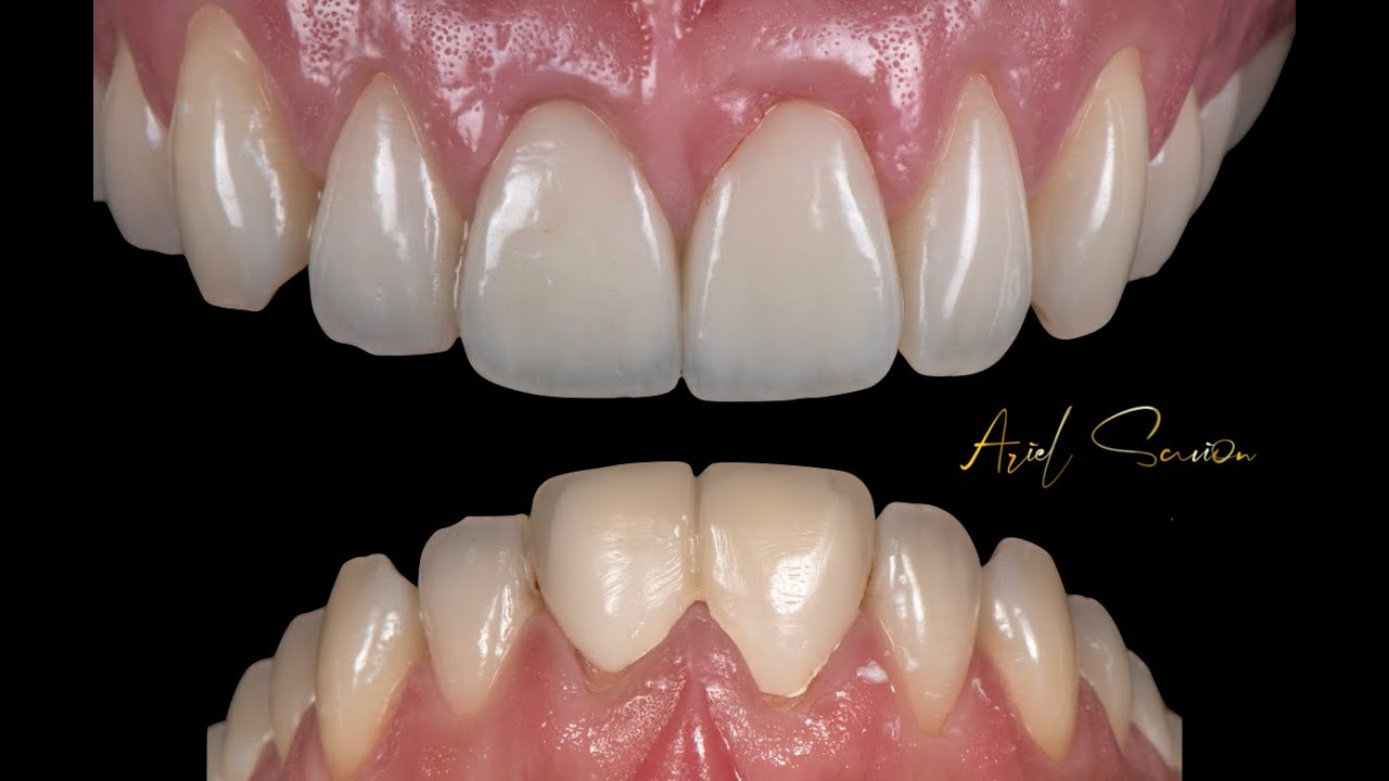 DENTAL ZIRCONIA CROWN WITH PERFECT COLOR MATCH - YouTube