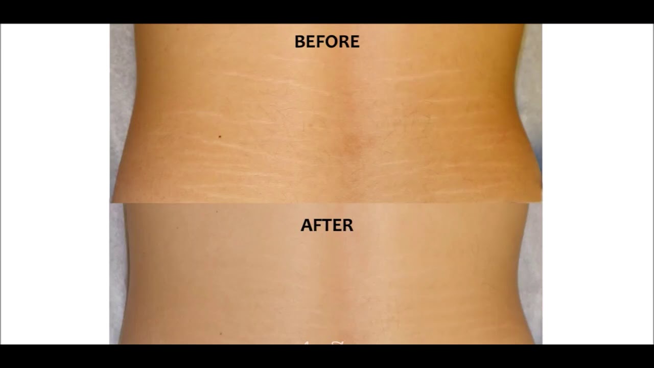 Laser Fractional (Stretch Mark) - YouTube
