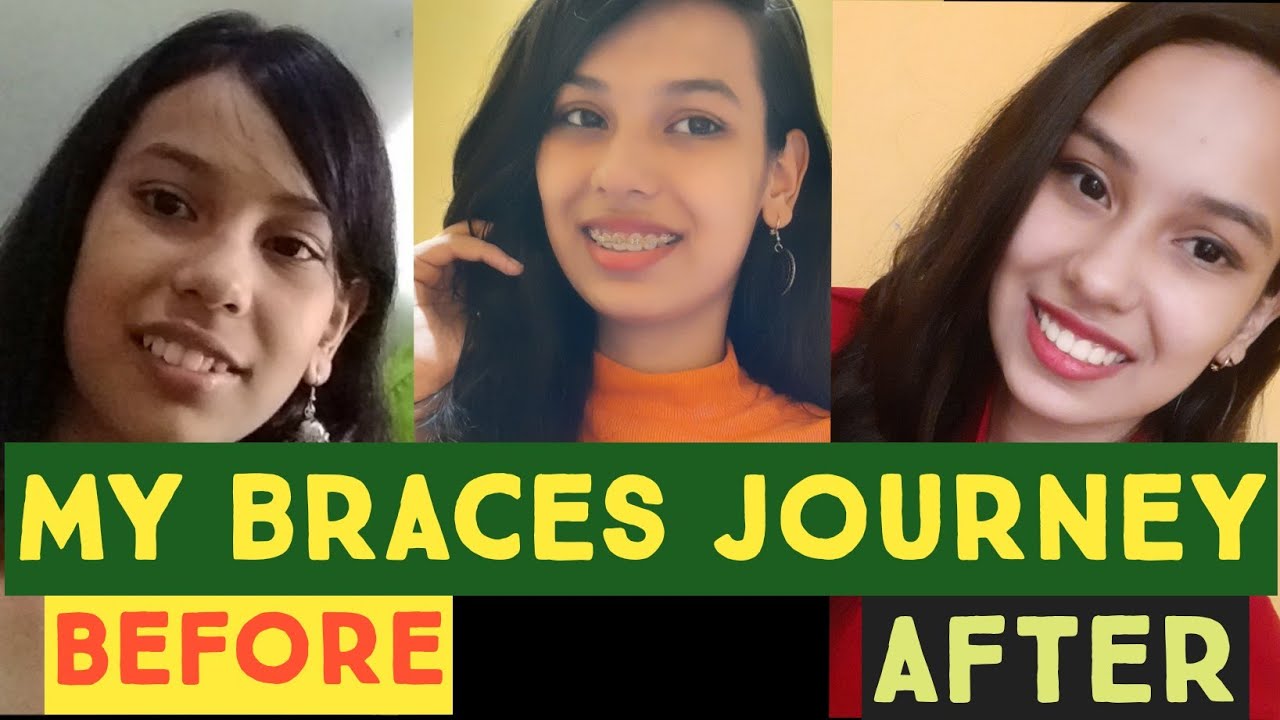 braces time lapse/My braces journey/q n a related to braces/all about ...