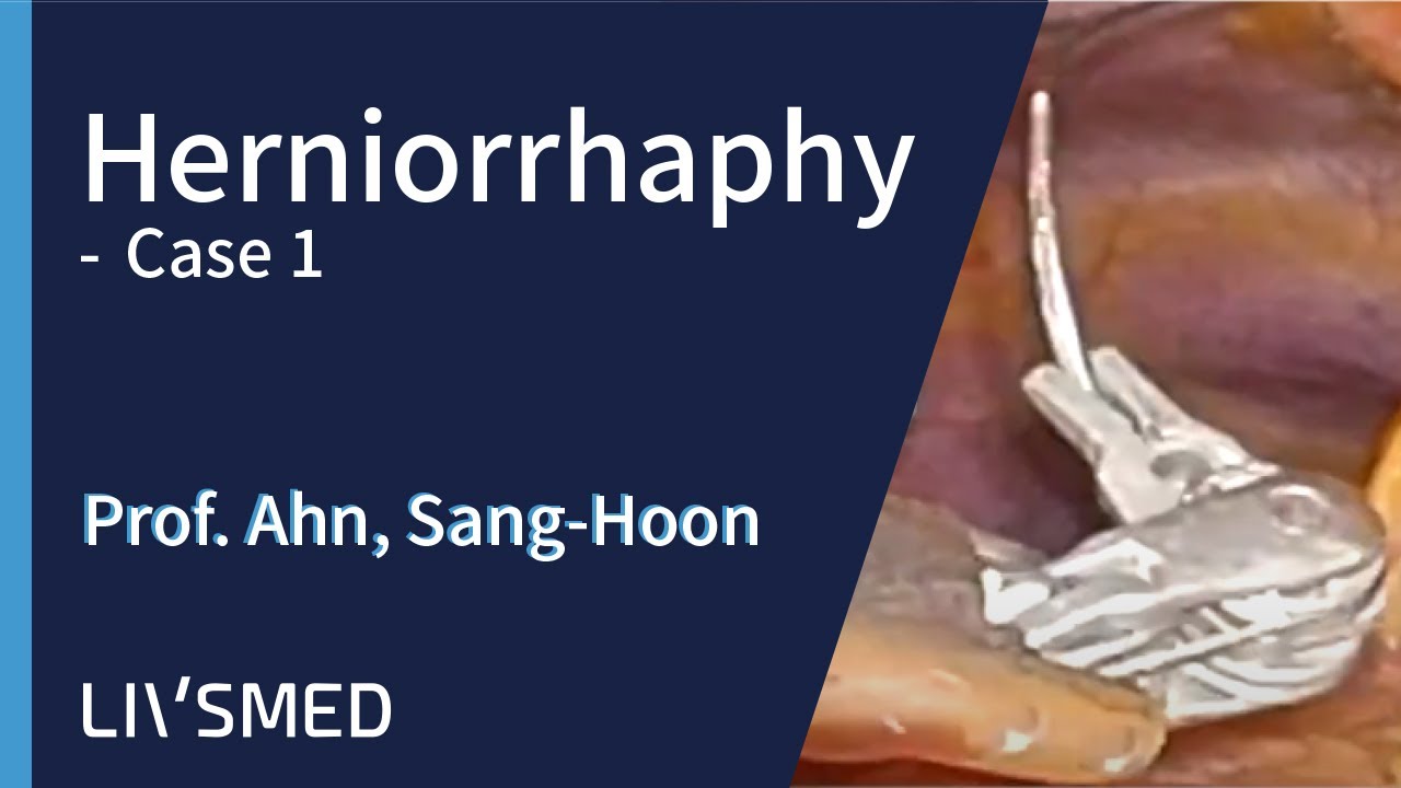 Herniorrhaphy - Prof. Ahn, Sang-Hoon - YouTube