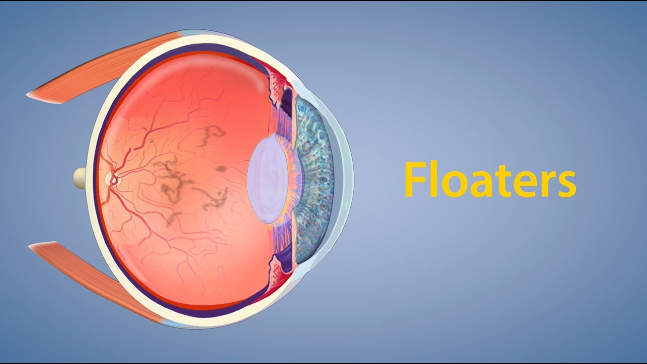 What are eye floaters? | An Optometrist Explains | True Eye Experts ...