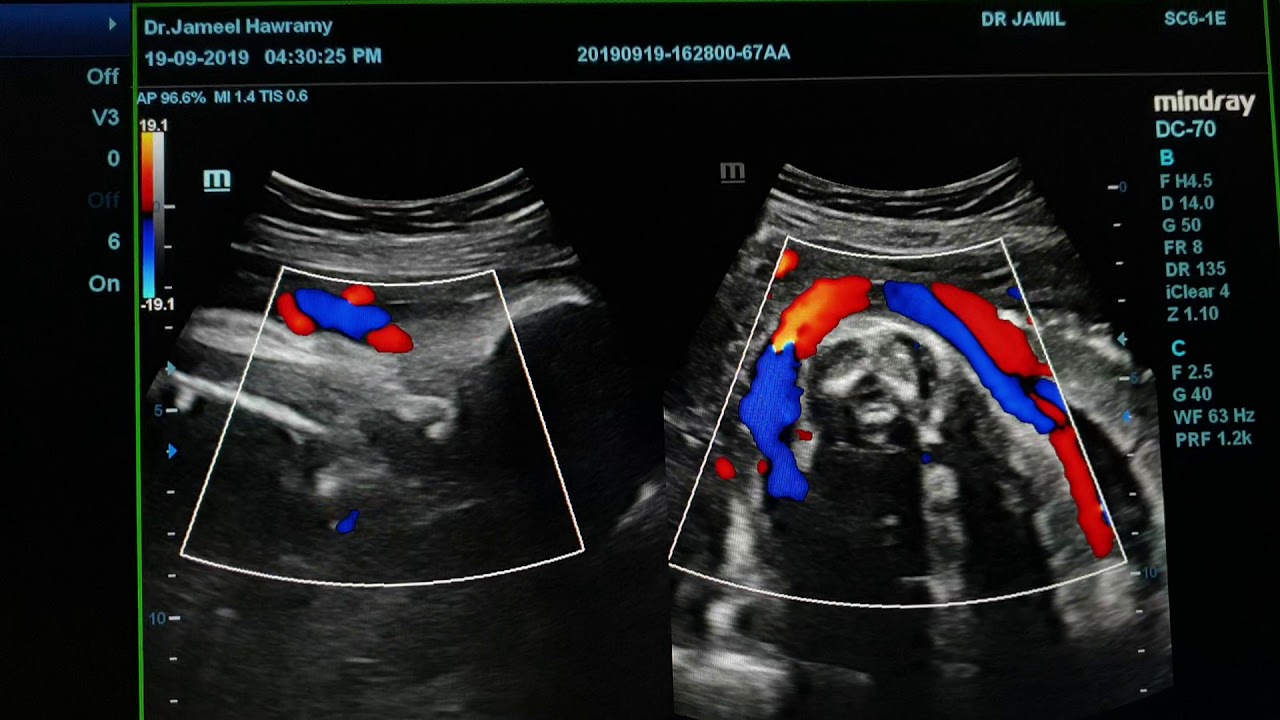 3 Loops Nuchal Cord Ultrasound YouTube