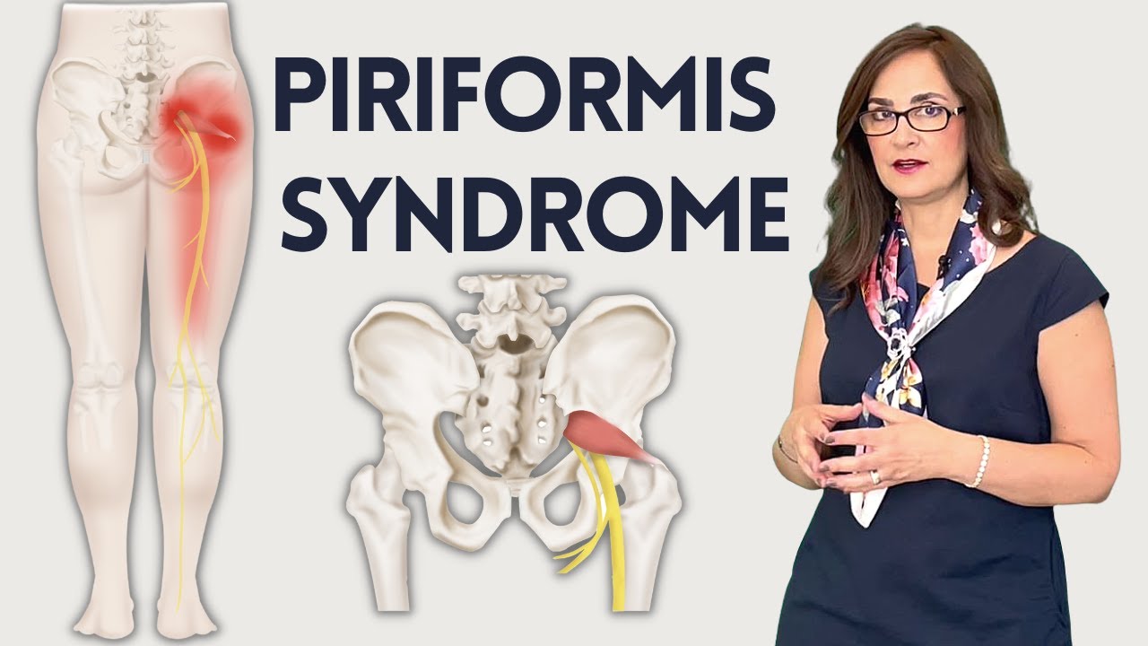 Piriformis Pain 🥇 NYC Piriformis Syndrome Treatment, Symptoms,