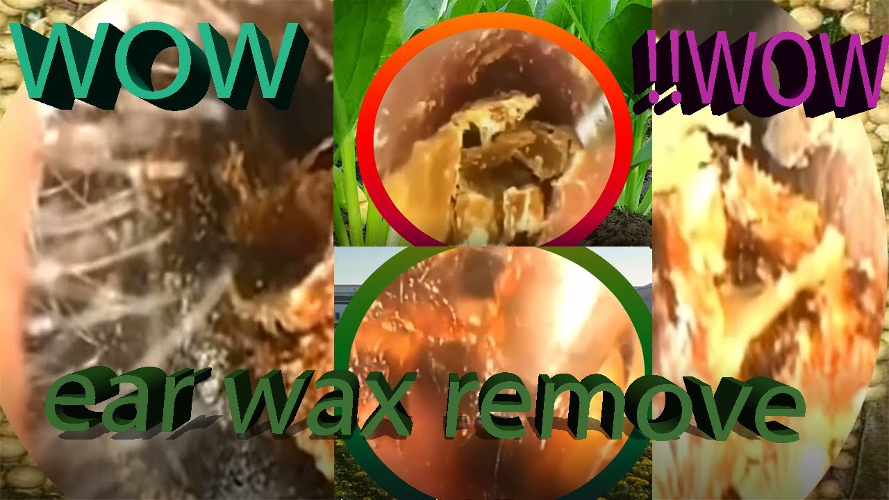 Huge Tonsil Stones Ear wax Removal in a case of Chronic Tonsillitis ...