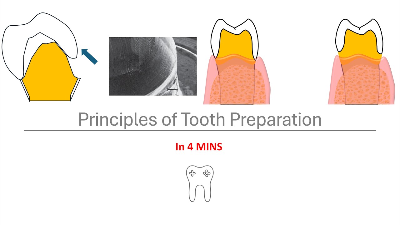 Principles of crown preparation - YouTube