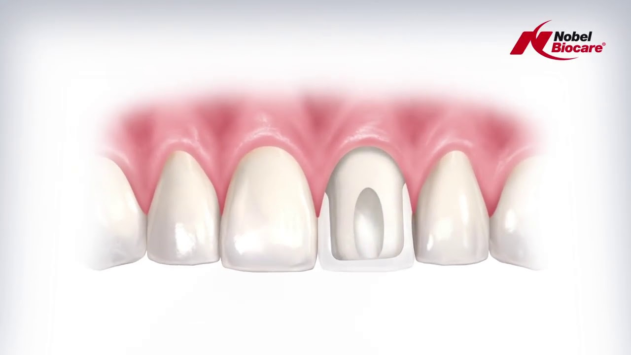 Nobel biocare ASC - YouTube