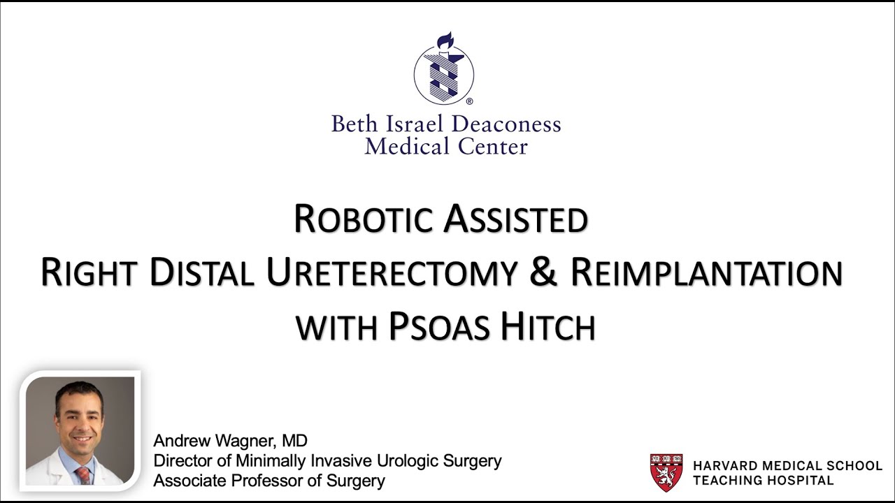 Right Distal Ureterectomy + Reimplant w/ Psoas Hitch - YouTube
