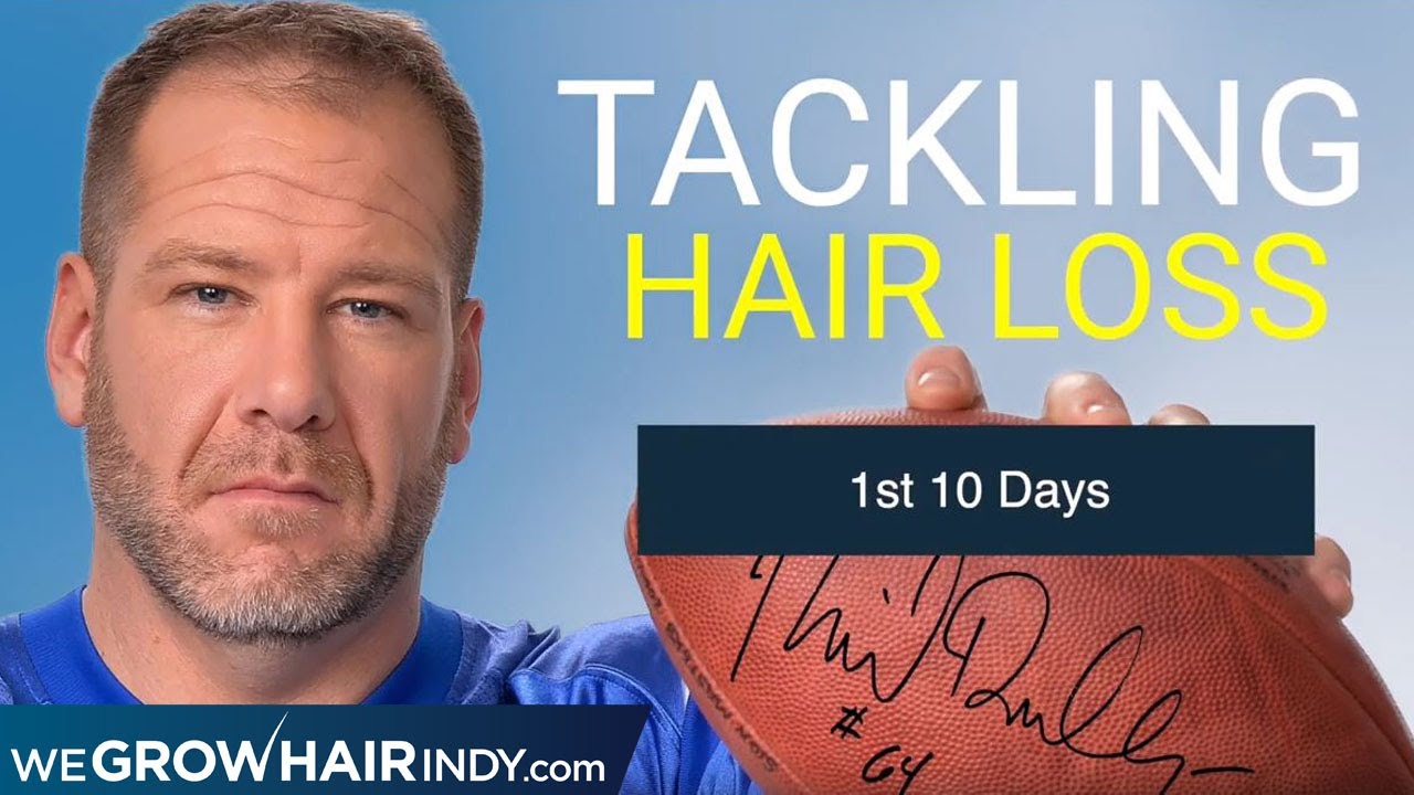 Rick DeMulling 10 Days After Multi-Unit Hair Grafting™ Hair Transplant ...