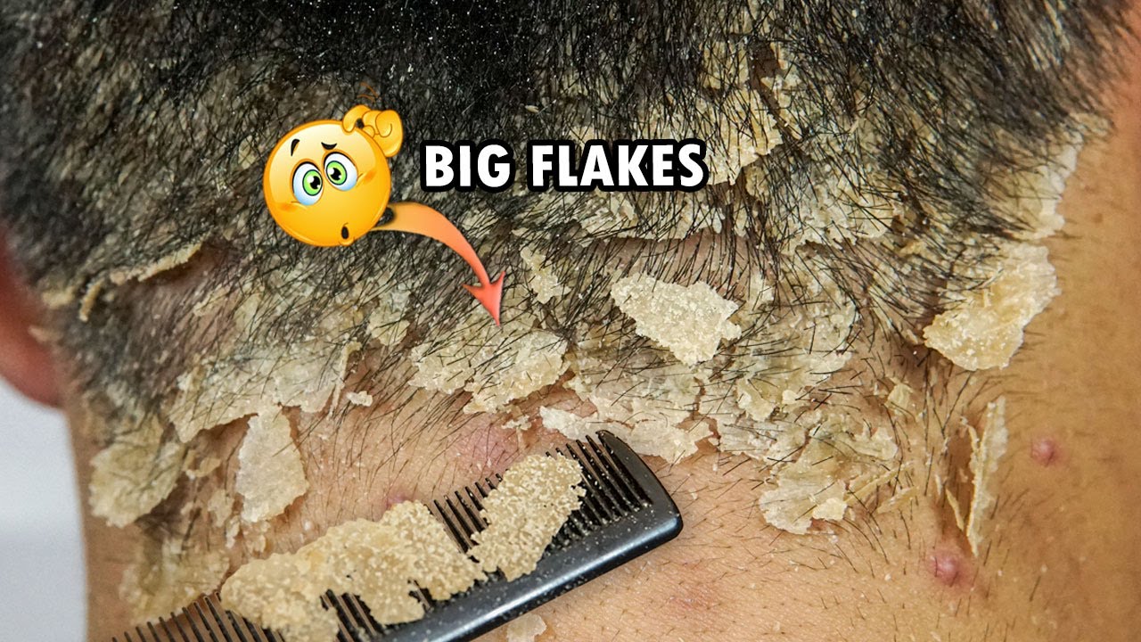 Dandruff Scratching Back Of Head #651 - YouTube
